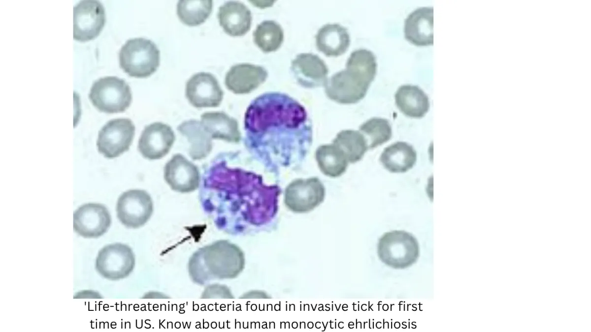 'Life-threatening' bacteria found in invasive tick for first time in US ...